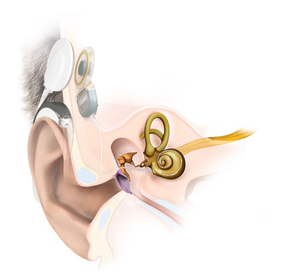 Cochlear Implants - Shea Clinic Ear Nose & Throat